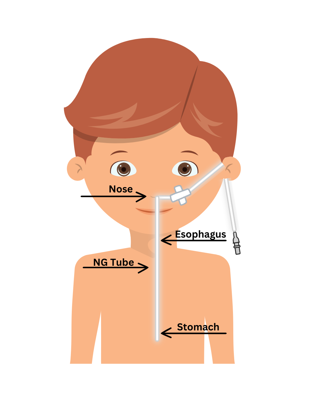 NG Tube Hospital Clean out - GI for Kids